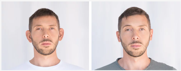 Otoplasty: Expert Insights | Raggio MD Facial Plastic Surgery
